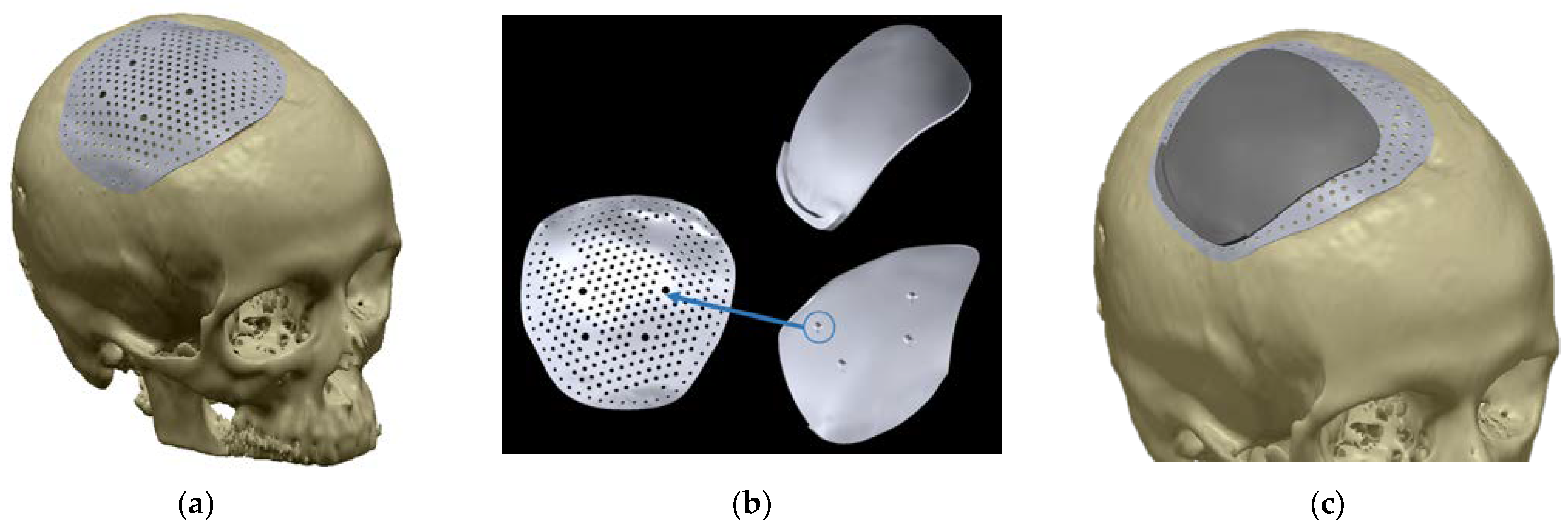 Additive Manufacturing and Reverse Engineering in Cranioplasty: A ...