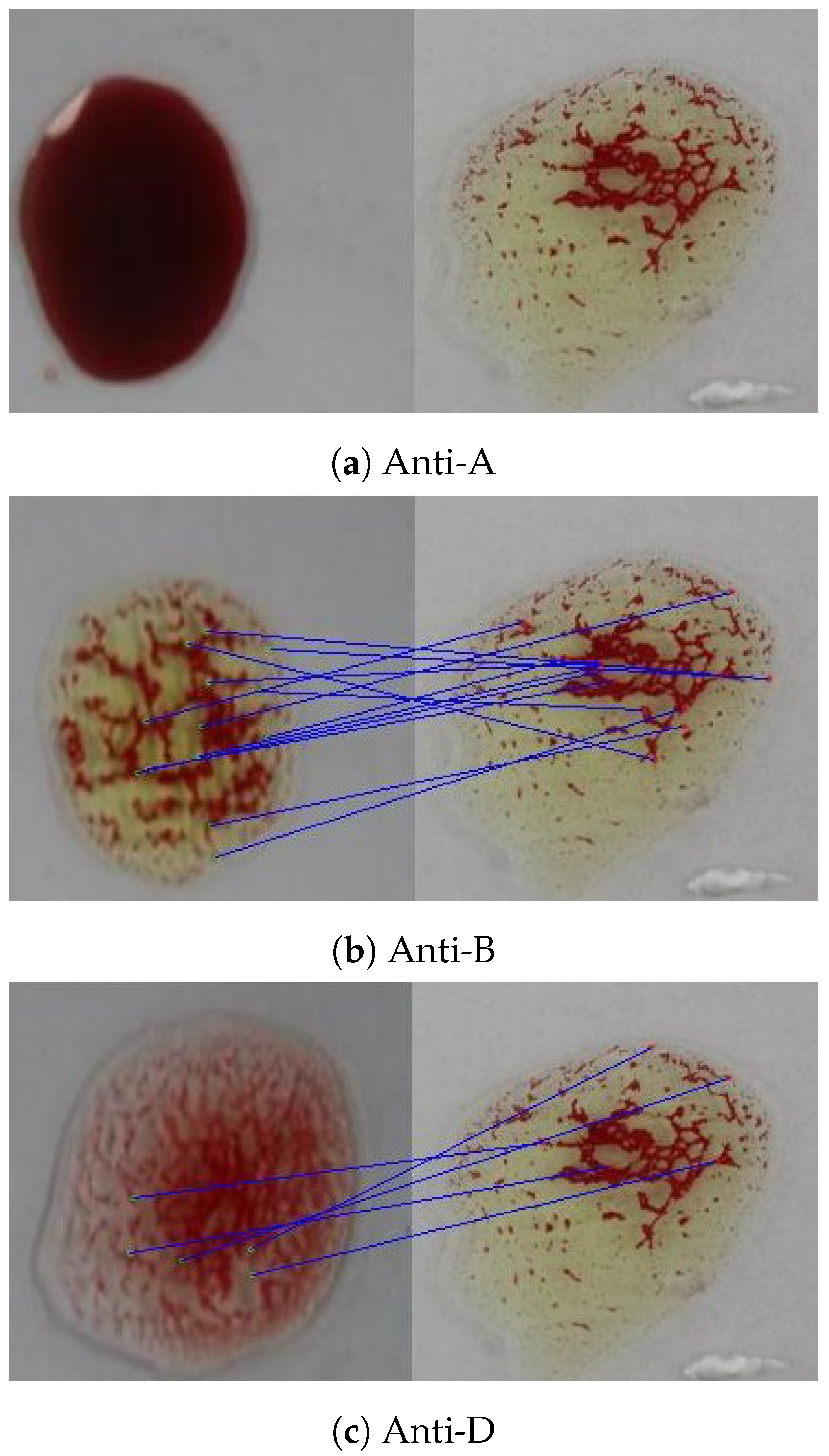 An Efficient System for Automatic Blood Type Determination Based on ...