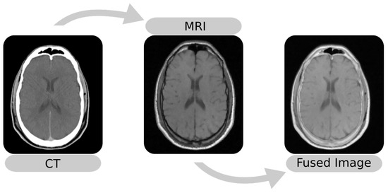 MRI and CT Fusion in Stereotactic Electroencephalography: A Literature ...