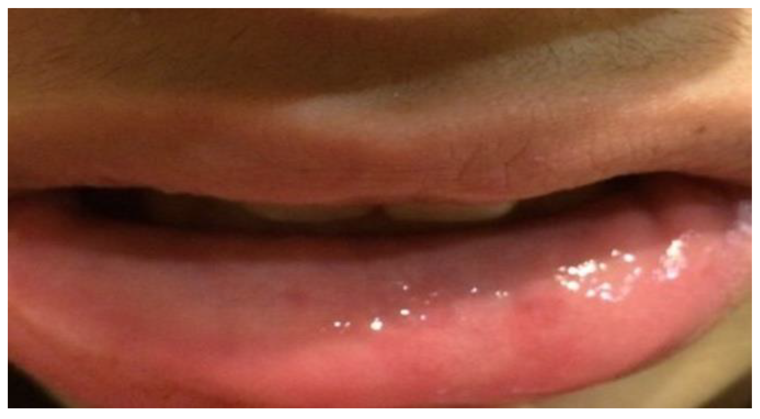 Biopsy Lip Cpt
