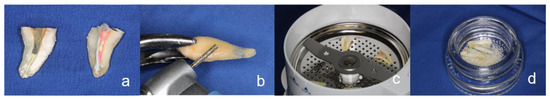 Retrospective Study on Tooth Shell Technique Using Endodontically ...