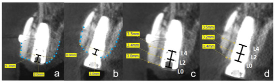 Retrospective Study on Tooth Shell Technique Using Endodontically ...