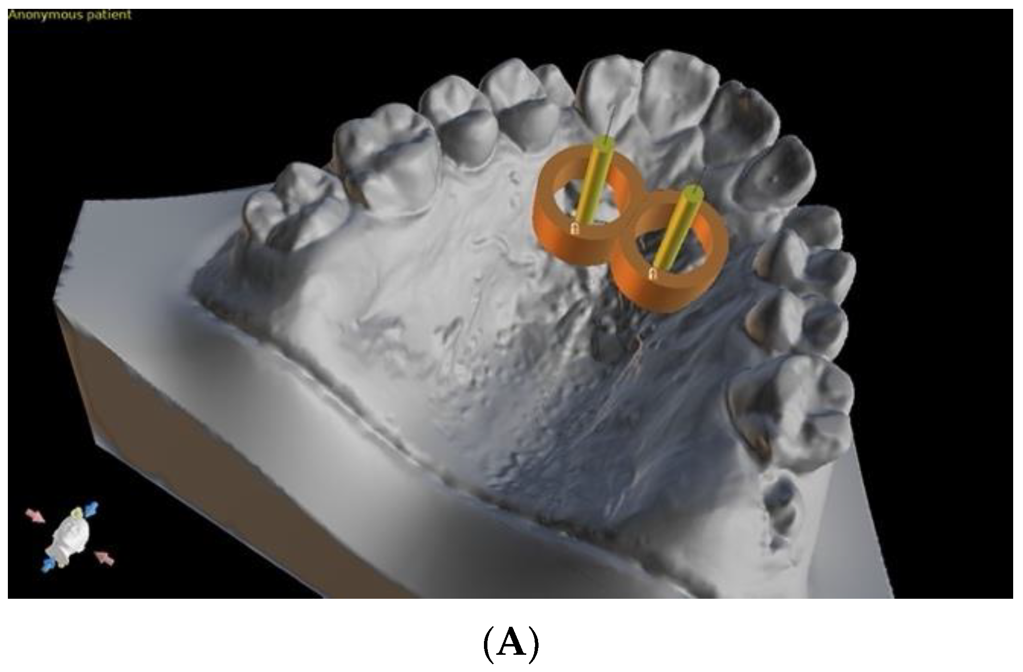 Digital (R)Evolution: Open-Source Softwares for Orthodontics