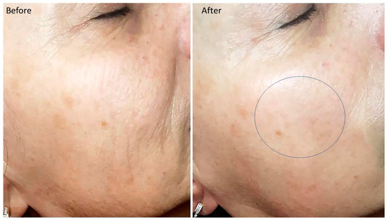Facial Anti-Aging Treatments with Soft Peeling and Microneedling Technique