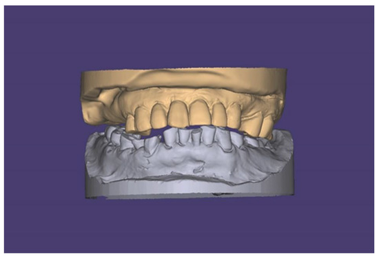 Alteration of the Occlusal Vertical Dimension for Prosthetic ...