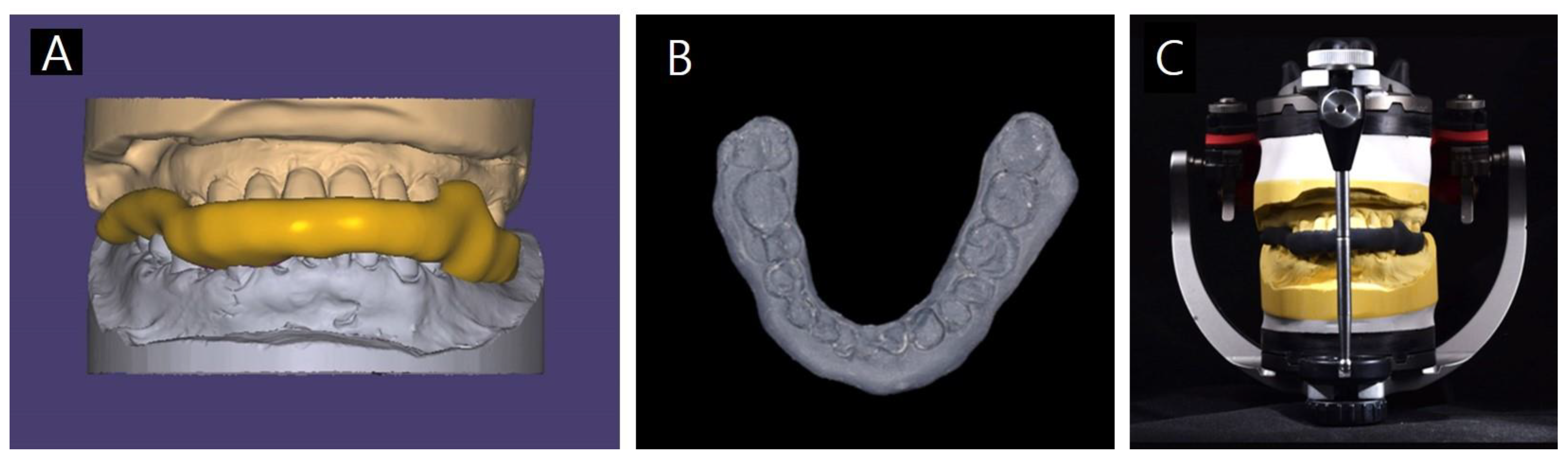 Alteration of the Occlusal Vertical Dimension for Prosthetic ...