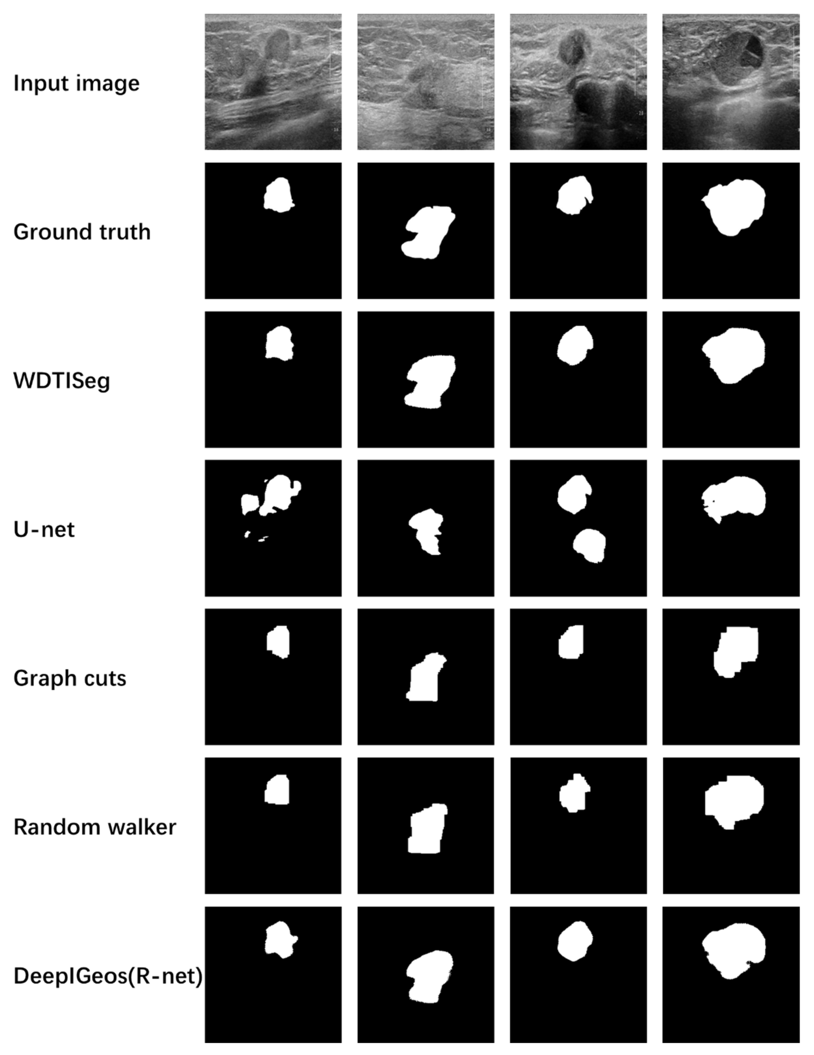 WDTISeg: One-Stage Interactive Segmentation for Breast Ultrasound Image ...