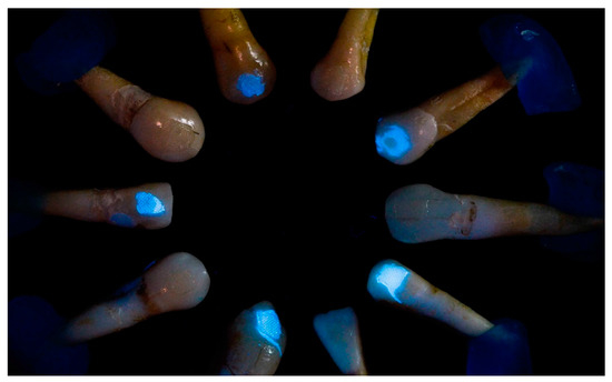 Evaluation of Dental Surface after De-Bonding Orthodontic Bracket ...