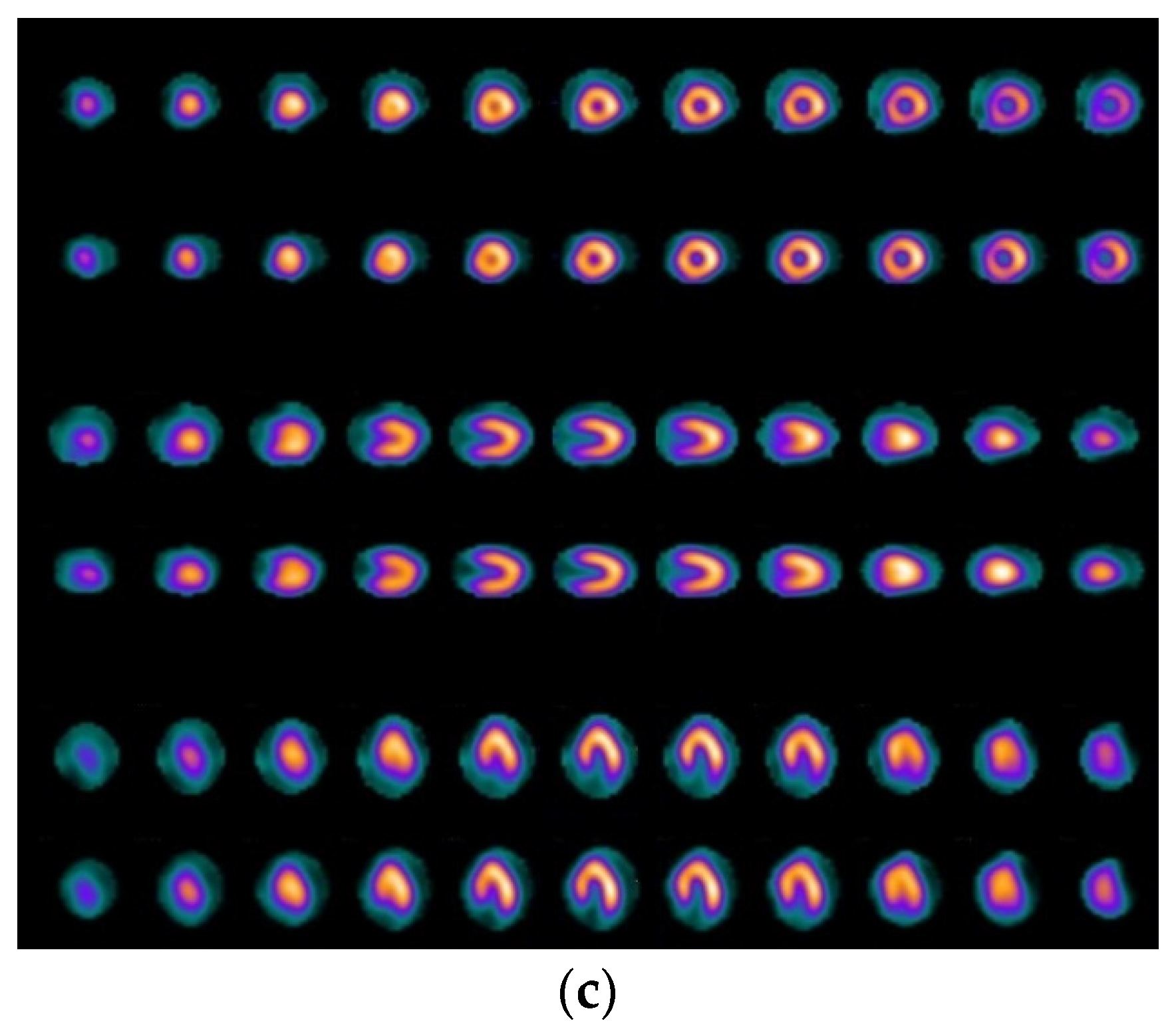 Automatic Diagnosis of Coronary Artery Disease in SPECT Myocardial ...