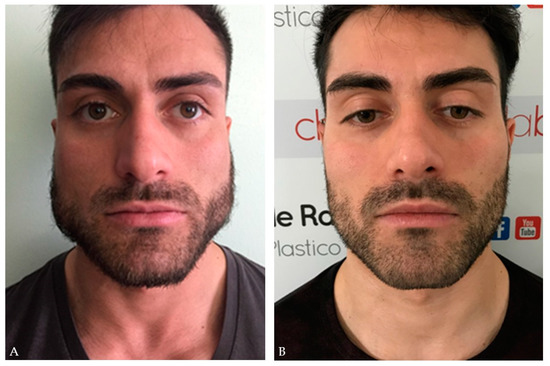 Biphasic Injection for Masseter Muscle Reduction with Botulinum Toxin