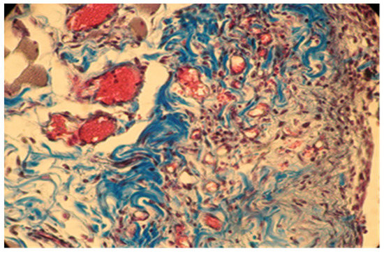 In Vivo Evaluation of Biocompatibility of Three Biomaterials Used in ...