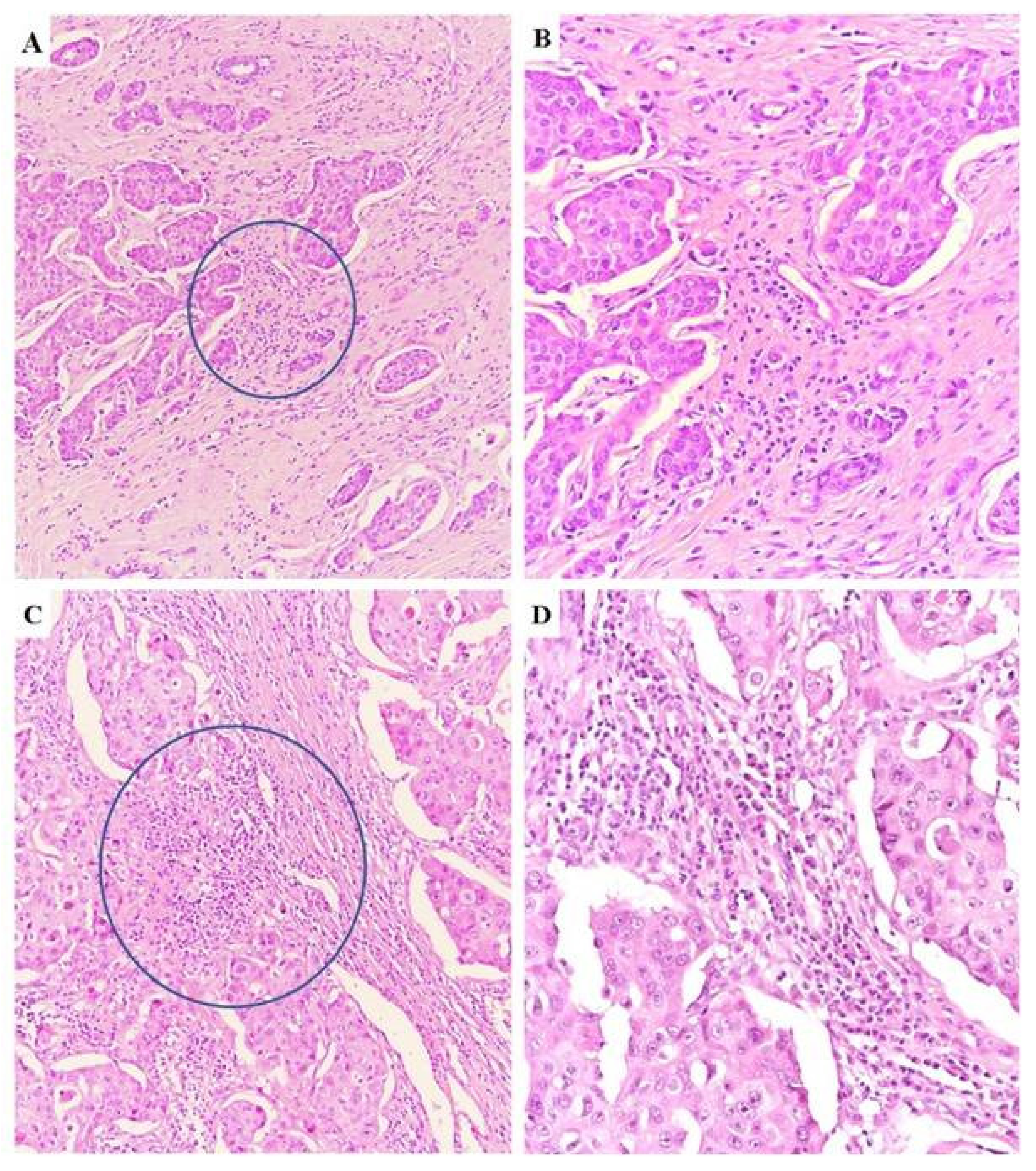 Histopathological Evaluation of Tumor-Infiltrating Lymphocytes (TILs ...