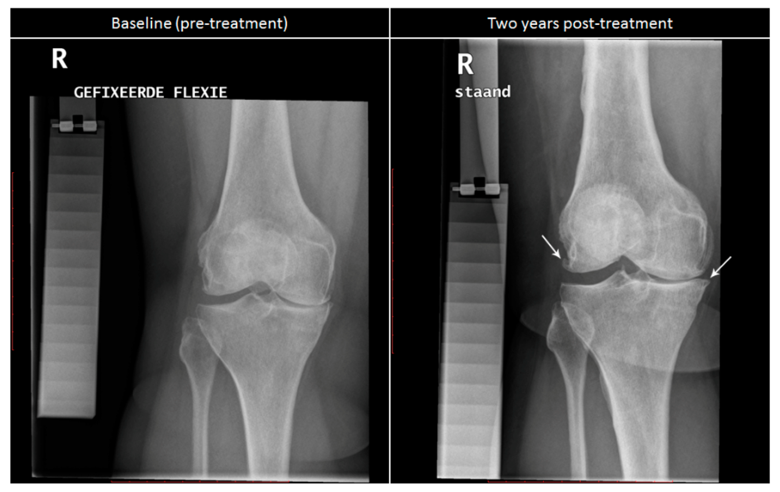 Cartilage Repair Activity during Joint-Preserving Treatment May Be ...