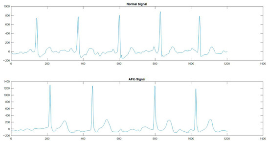 System for Neural Network Determination of Atrial Fibrillation on ECG ...