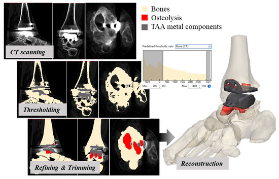 Volume and Distribution of Periprosthetic Bone Cysts in the Distal ...