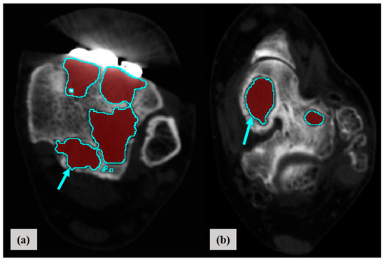 Volume and Distribution of Periprosthetic Bone Cysts in the Distal ...