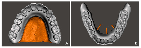 Fabrication of Metal-Reinforced Complete Dentures Using the CAD-CAM ...