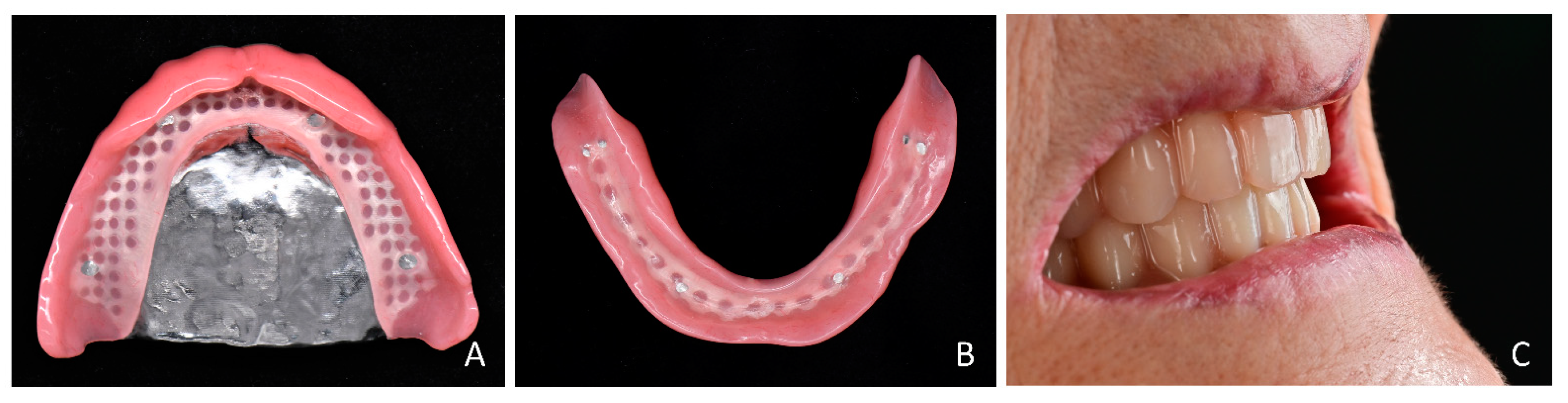 Fabrication of Metal-Reinforced Complete Dentures Using the CAD-CAM ...