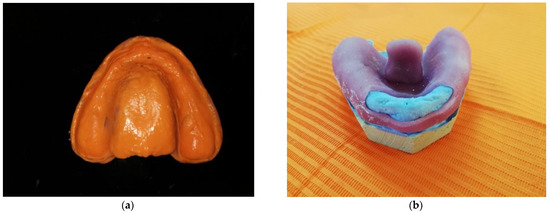 Flabby Ridge, a Challenge for Making Complete Dentures