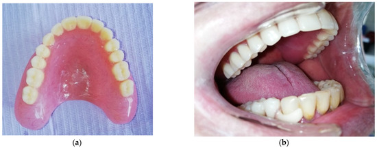 Flabby Ridge, a Challenge for Making Complete Dentures