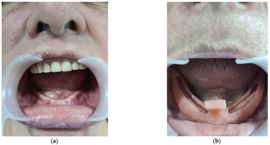 Flabby Ridge, a Challenge for Making Complete Dentures