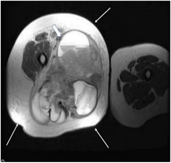Synovial Sarcoma of the Extremities: A Literature Review