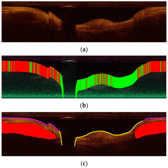 Automatic Classification of A-Lines in Intravascular OCT Images Using ...