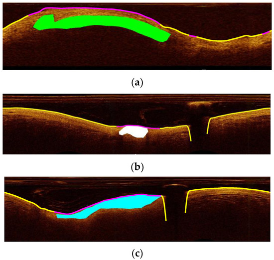 Automatic Classification Of A Lines In Intravascular Oct Images Using Deep Learning And