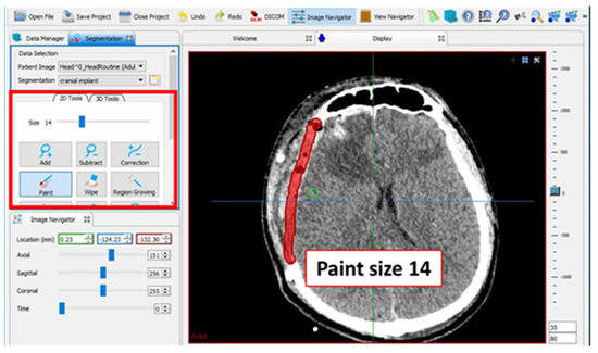 Cranial Implant Design Applying Shape-Based Interpolation Method via ...