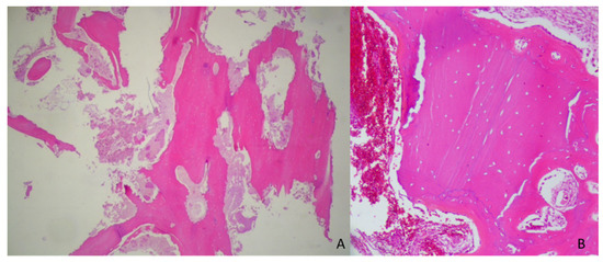 Intraosseous Squamous Cell Carcinoma Associated with Denosumab-Induced ...