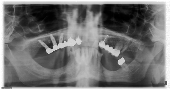 Basic Knowledge and New Advances in Panoramic Radiography Imaging ...