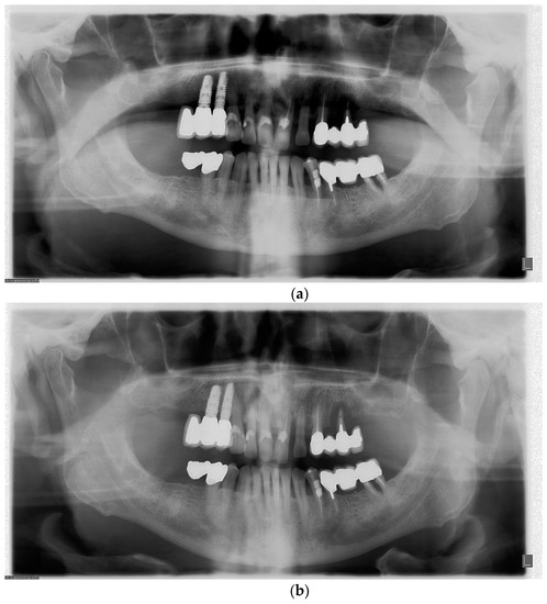 Basic Knowledge and New Advances in Panoramic Radiography Imaging ...