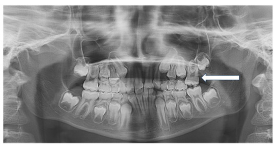 Ectopic Eruption of the First Permanent Molar in the Maxilla ...