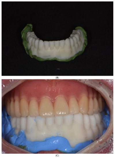 Digital Denture Fabrication: A Technical Note