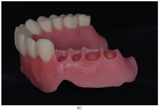 Digital Denture Fabrication: A Technical Note