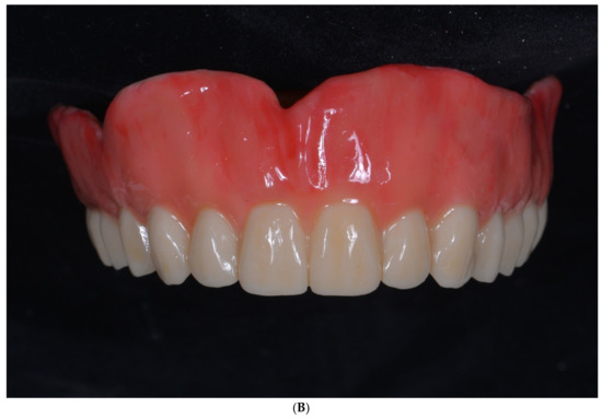 Digital Denture Fabrication: A Technical Note