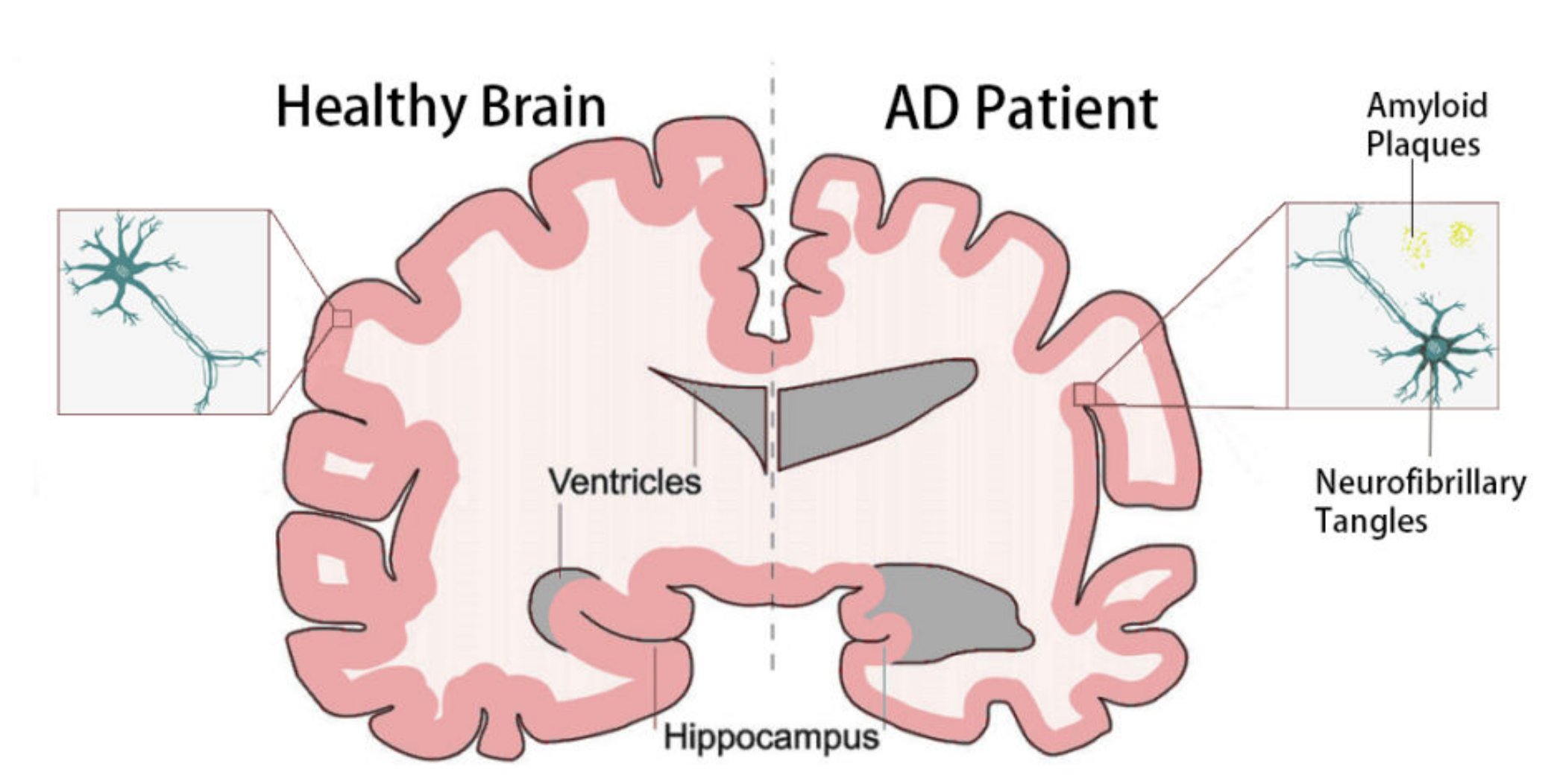 Computer-Aided Diagnosis of Alzheimer’s Disease via Deep Learning Models and Radiomics Method
