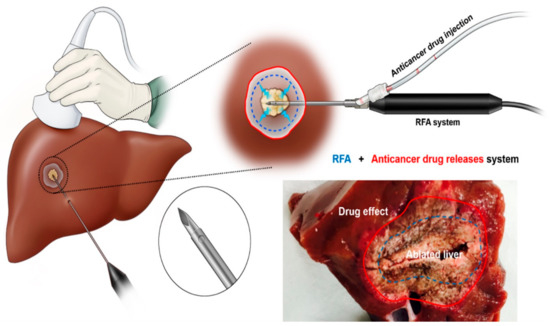 Feasibility of a Drug-Releasing Radiofrequency Ablation System in a Porcine Liver Model