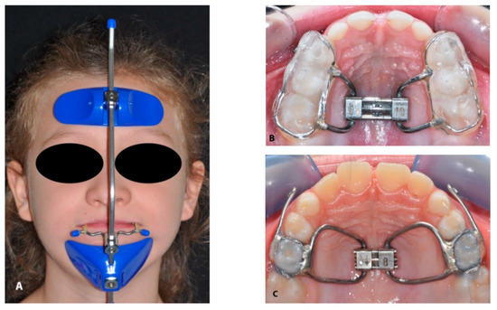 Postpubertal Effects of the Rapid Maxillary Expansion and Facial Mask ...