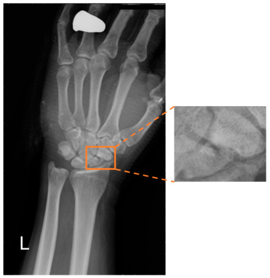 High-Performance Scaphoid Fracture Recognition via Effectiveness ...