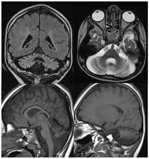 Neuroimaging of Pediatric Cerebellum in Inherited Neurodegenerative ...
