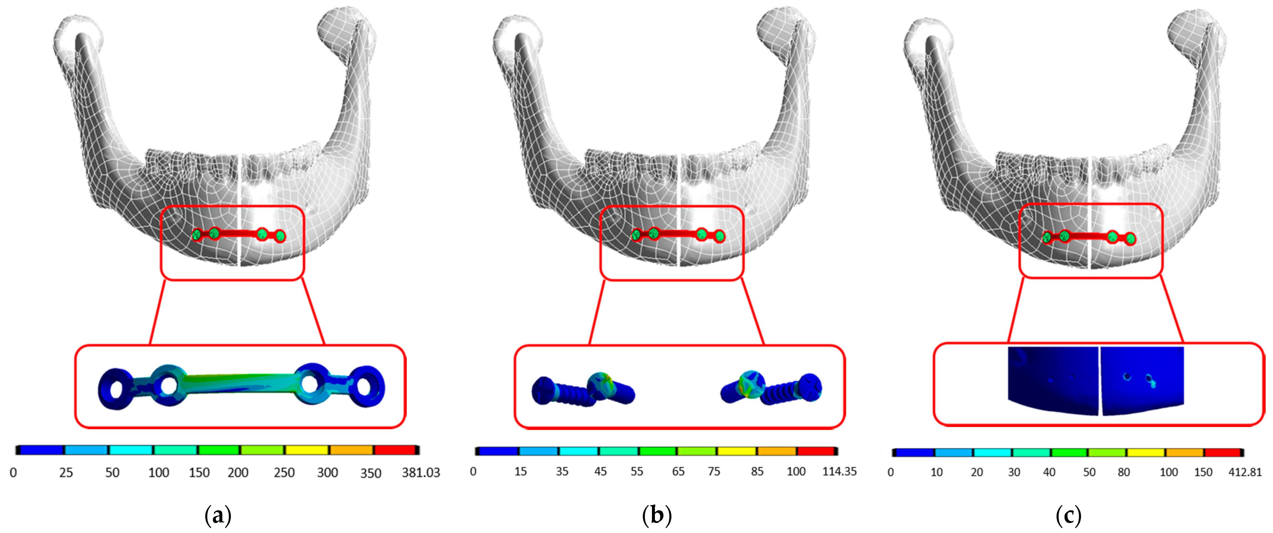 Is Perpendicular Double Two-Hole Plates Fixation Superior to Single ...