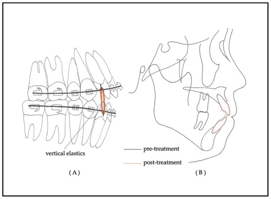 Treatment Option Criteria for Open Bite with Receiver Operating ...