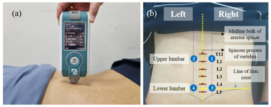 Intramuscular Properties of Resting Lumbar Muscles in Patients with ...