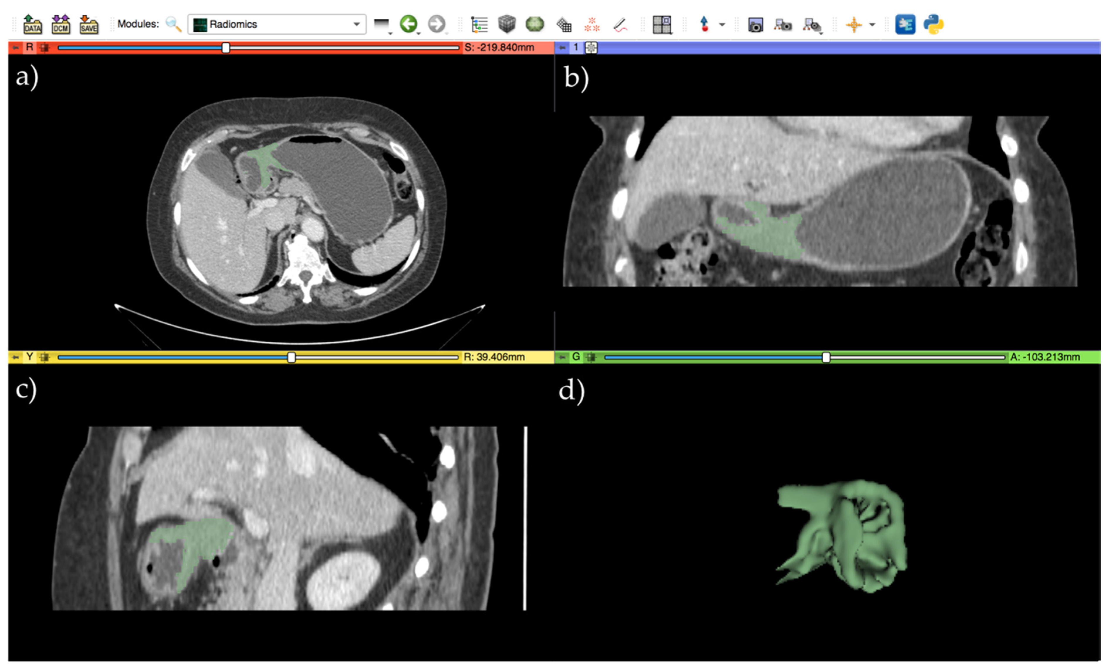 Perioperative Chemotherapy with FLOT Scheme in Resectable Gastric ...