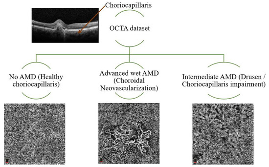 Choroidal Neovascularization Screening on OCT-Angiography ...
