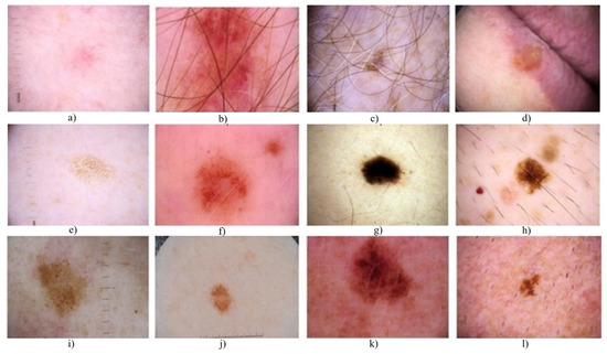 A Reinforcement Learning Algorithm for Automated Detection of Skin Lesions
