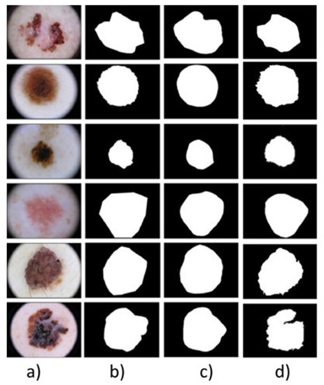 A Reinforcement Learning Algorithm for Automated Detection of Skin Lesions