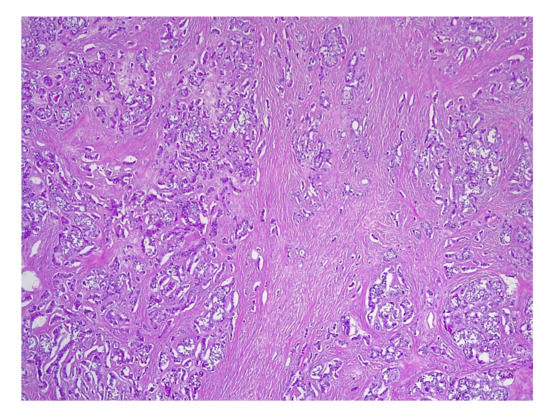 Struma Ovarii: Clinico-Morphological Features and Therapeutic ...