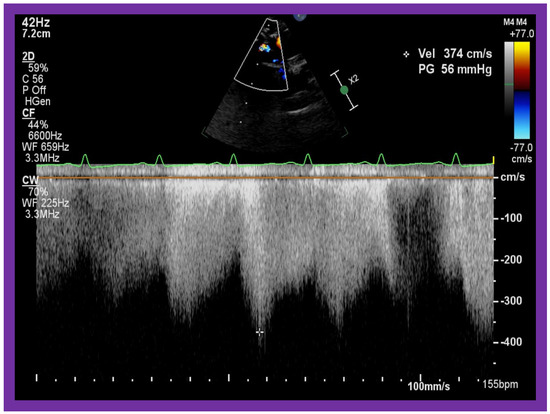 Echocardiography in the Diagnosis and Management of Tricuspid Atresia